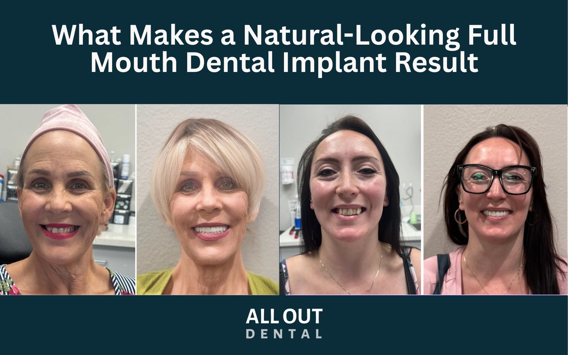 What Makes a Natural-Looking Full Mouth Dental Implant Result - 3 on 6 ...