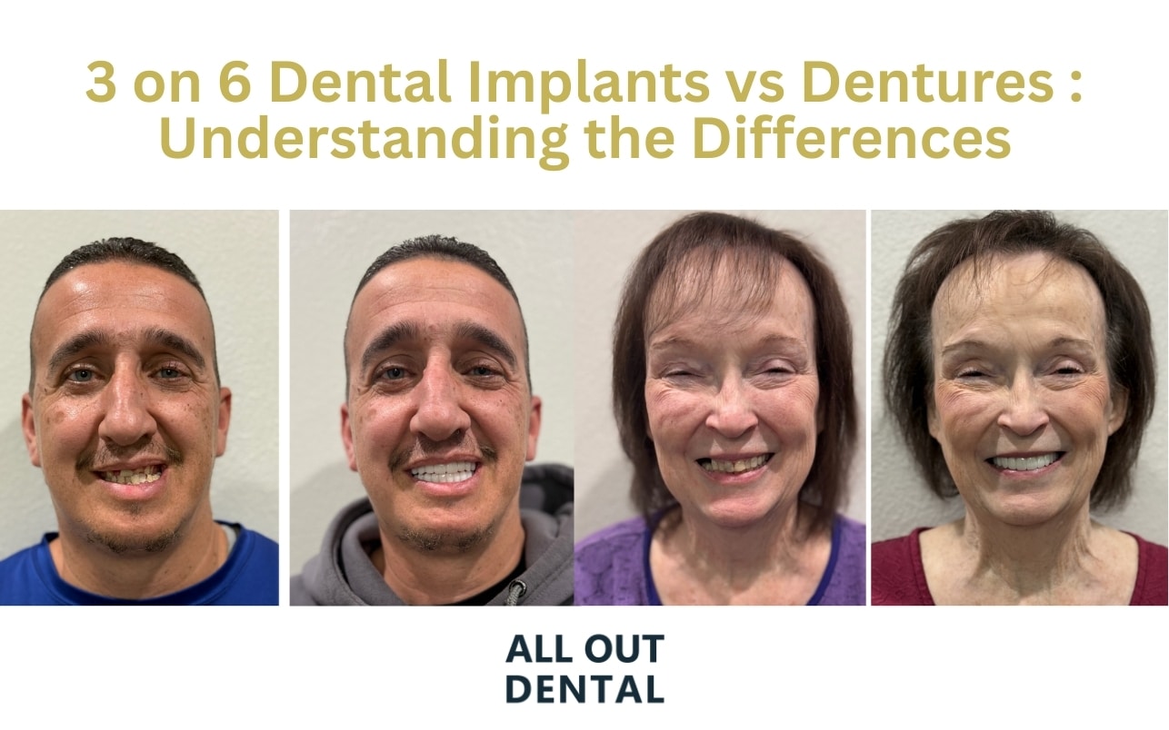 3 on 6 Dental Implants vs Dentures Explained